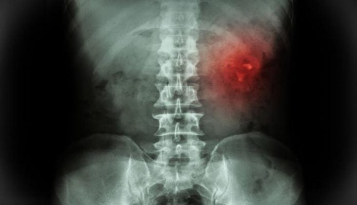 CÁLCULO RENAL (Pedras nos Rins) - Causas, Sintomas e Tratamento » MD.Saúde CÁLCULO RENAL (Pedras nos Rins) - Causas, Sintomas e Tratamento » MD.Saúde