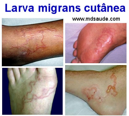 Ocular Larva Migrans.