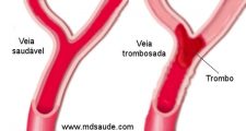 Trombose Venosa Profunda (TVP) - Trombose na Perna