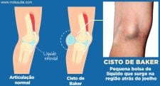 CISTO DE BAKER | O que é, como surge e tratamento