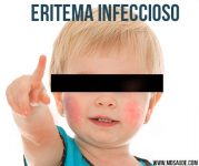 Eritema infeccioso: sintomas, transmissão e tratamento