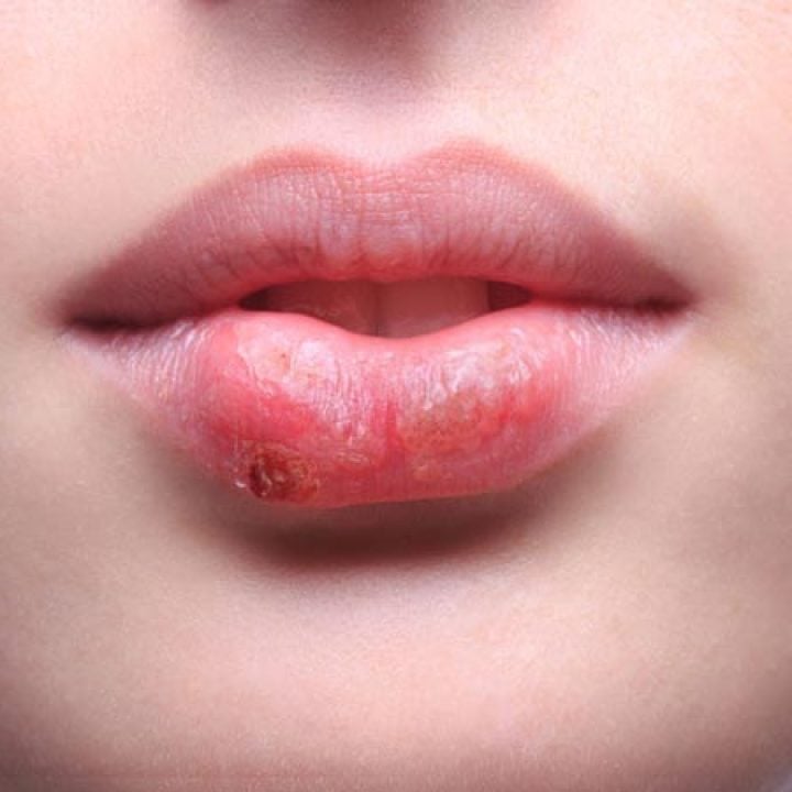 Herpes Labial Em Criancas