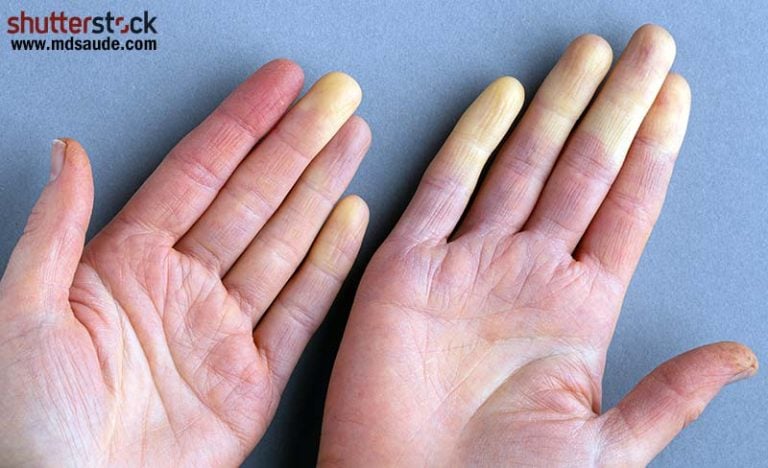 Fenómeno de Raynaud: qué es, síntomas y tratamiento