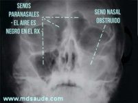 Sinusitis: qué es, síntomas y tratamiento