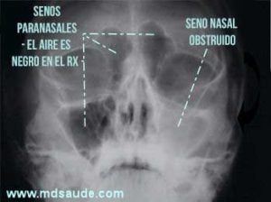 SINUSITIS – Síntomas y Tratamiento | MD.Saúde