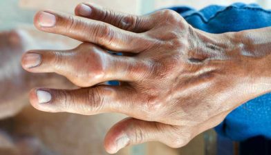 Gota (doença) | O que é, sintomas, crises e tratamento