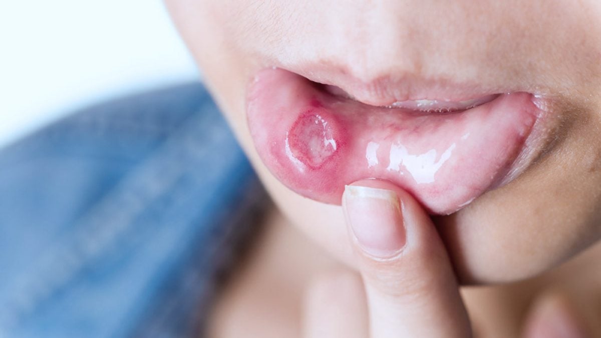 Aftas: quanto tempo demora para curar? Causas, sintomas e ...