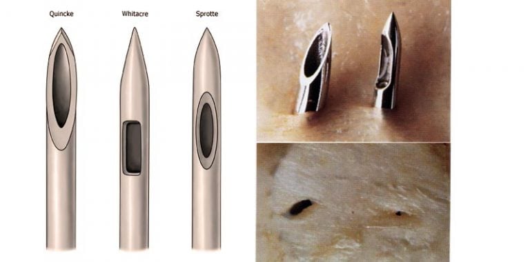 Dolor de cabeza por punción lumbar o anestesia raquídea
