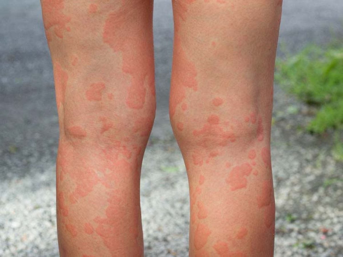 Alergia A Grama De Junho