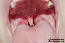 Photos: Tonsillitis and Pharyngitis