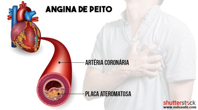 Angina Estável e Instável - Causas, Sintomas e Tratamento • MD.Saúde