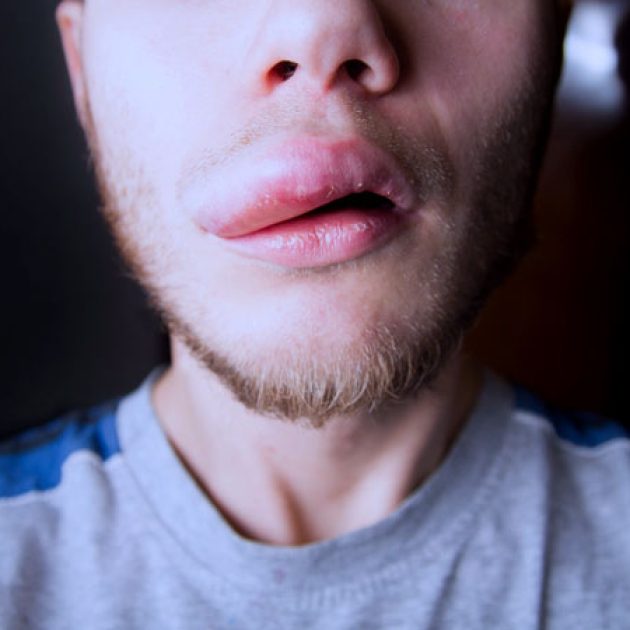 Angioedema Antes E Depois