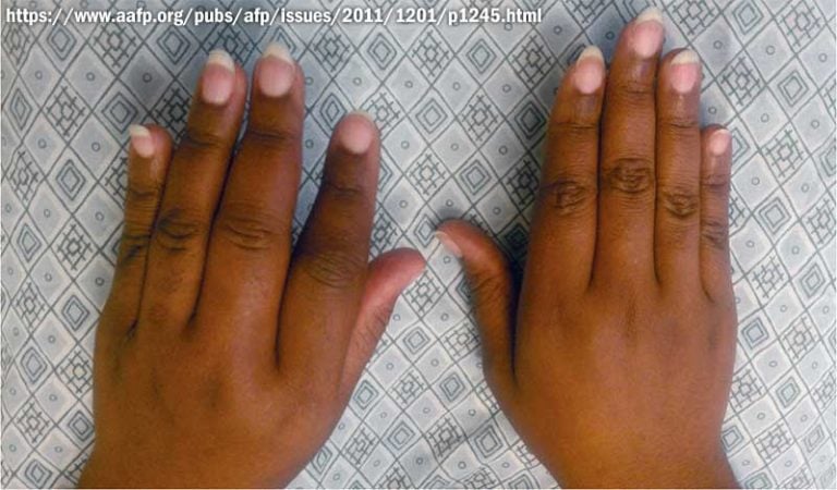 FOTOS | Artrite reumatoide