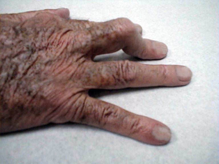 FOTOS | Artrite reumatoide