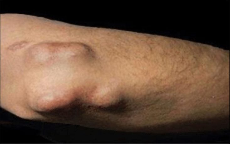 FOTOS | Artrite reumatoide