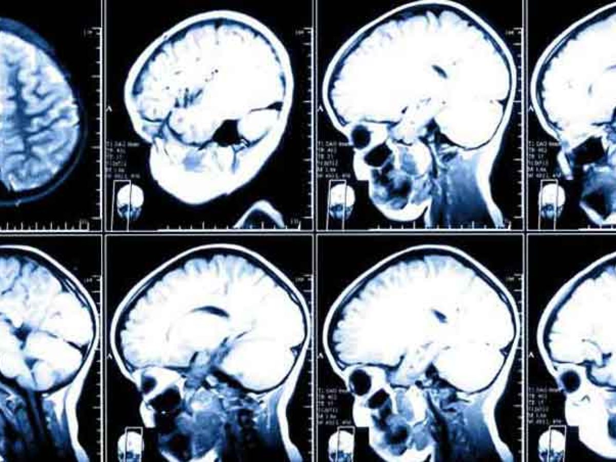 Síntomas De Un Accidente Cerebrovascular En La Cara