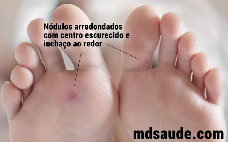 Bicho-do-pé (tungíase): o que é, sintomas e tratamento