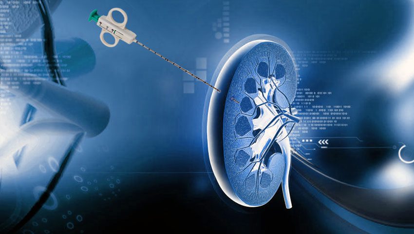 BIOPSIA RENAL – Indicaciones, precauciones y riesgos - MD.Saúde