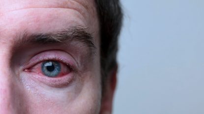 Blefarite: o que é, causas, sintomas e tratamento