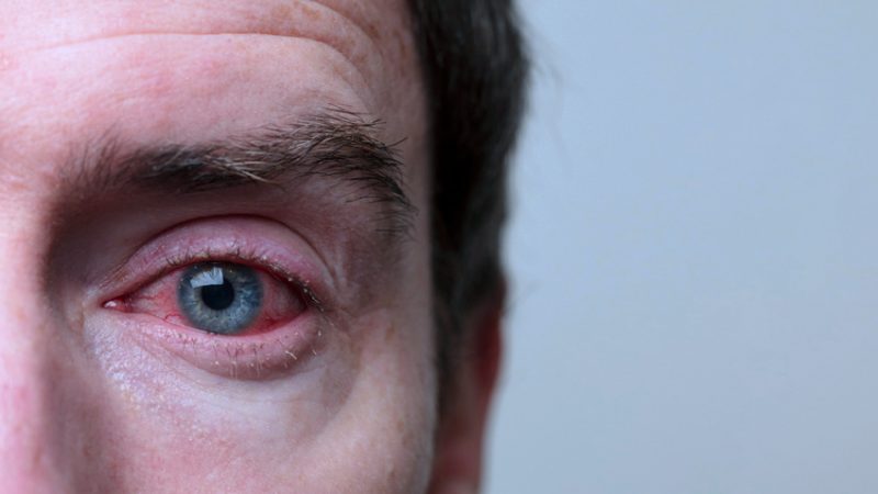 BLEFARITIS - Causas, síntomas y tratamiento • MD.Saúde