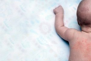 Dermatite da fralda - Como tratar e prevenir as assaduras? - MD.Saúde