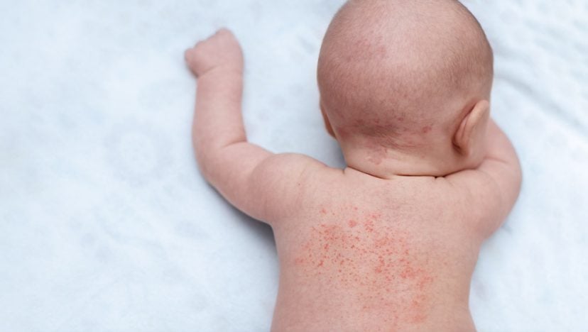 Fotos de dermatitis atópica (en bebés, niños y adultos)