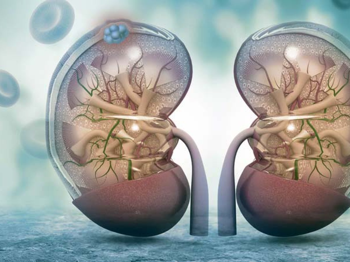 Estagios Do Cancer Renal