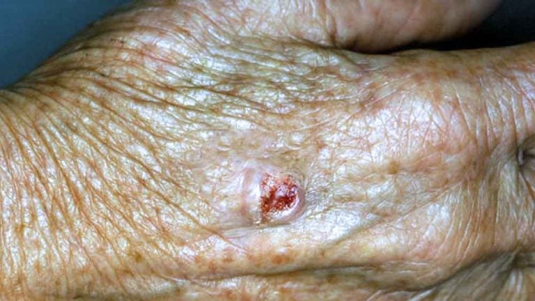 Carcinoma espinocelular: causas, sintomas e tratamento