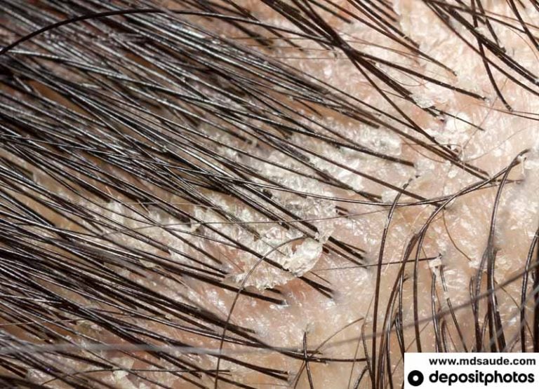 Caspa: causas, síntomas y tratamiento