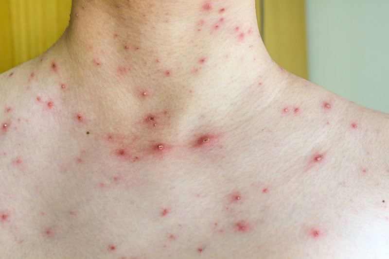 FOTOS: catapora (varicela) - pápulas, vesículas e crostas.