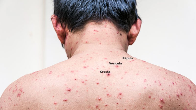FOTOS: catapora (varicela) - pápulas, vesículas e crostas.