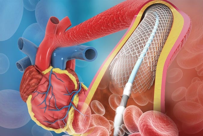 Cateterismo Cardíaco - Angioplastia com Stent - MD.Saúde