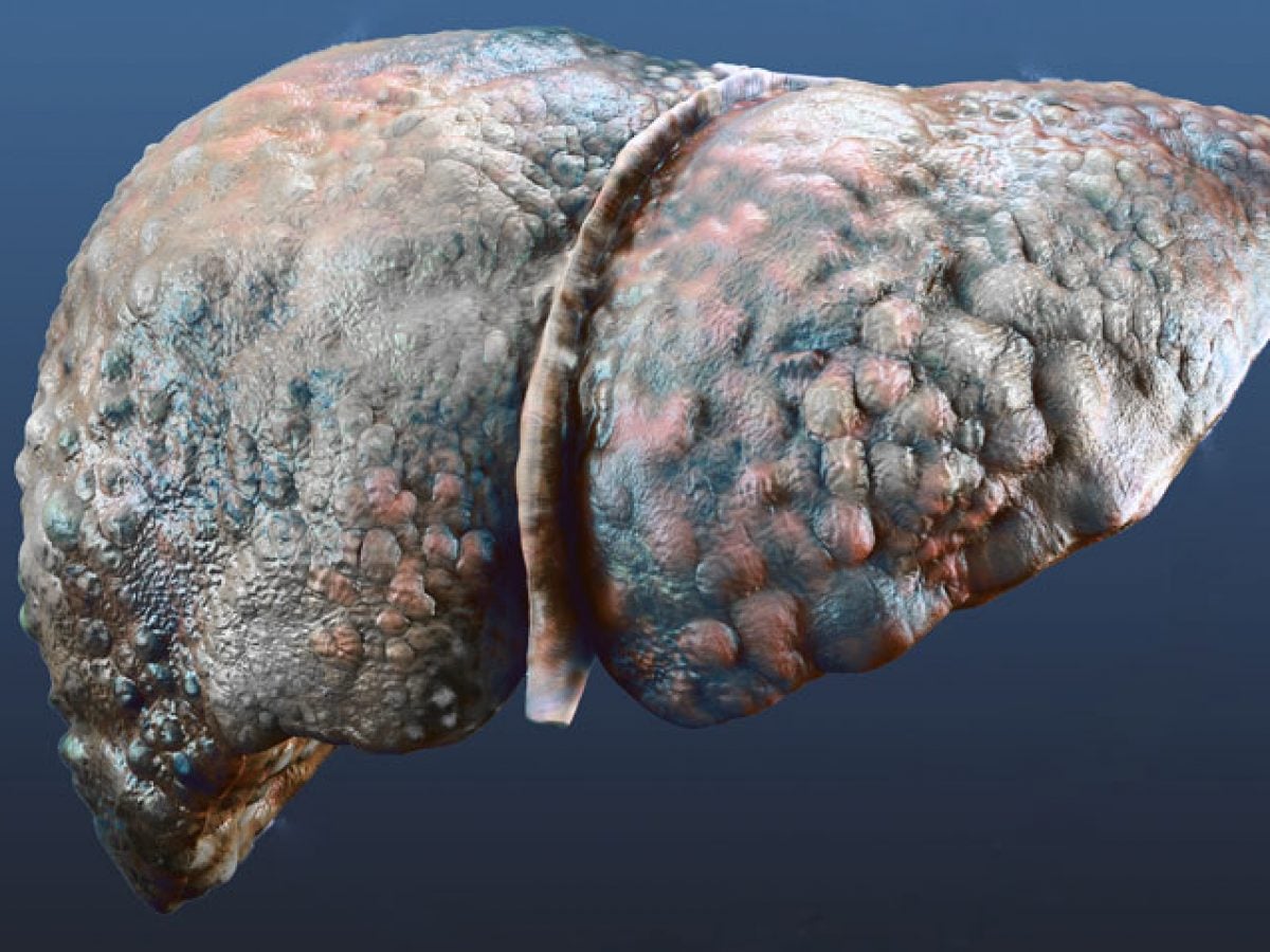 Hígado Afectado Por El Alcohol Antes Y Después