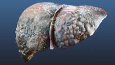 Cirrose hepática: o que é, sintomas, causas e tratamento