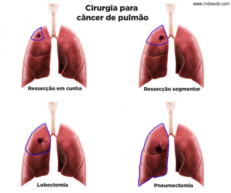 Câncer de pulmão | Sintomas, tratamento e chance de cura