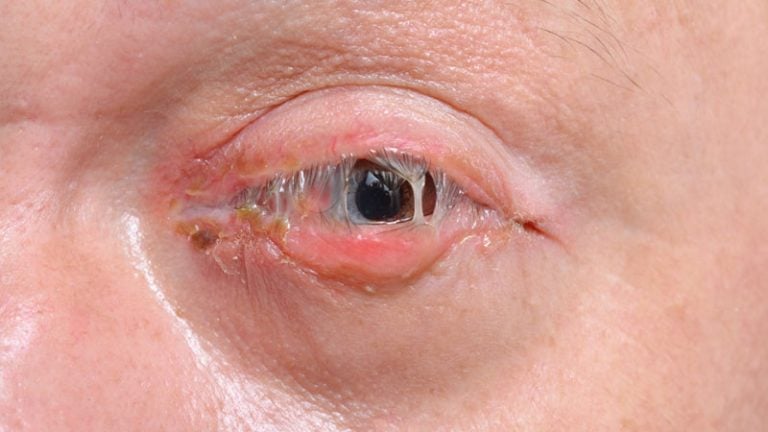 26 causas de olho vermelho e irritado (com fotos)