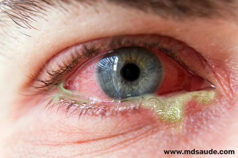 Fotos de conjuntivite (bacteriana, alérgica e viral)