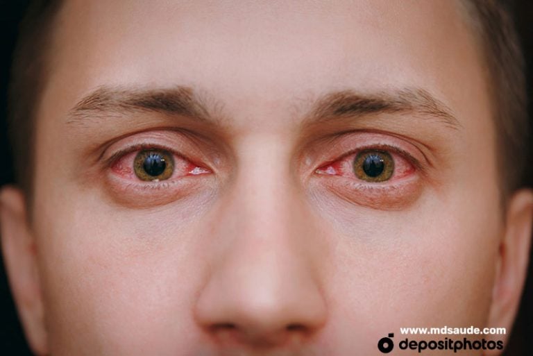 Conjuntivite alérgica: causas, sintomas e tratamento