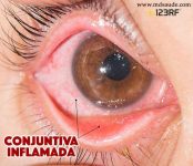 Conjuntivite alérgica: causas, sintomas e tratamento