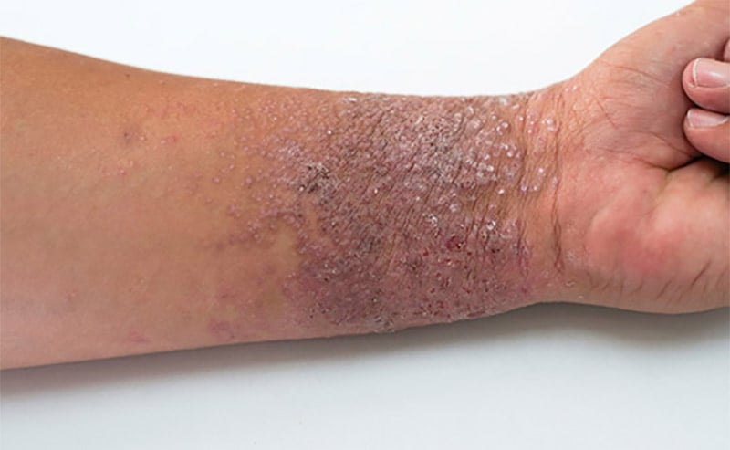 Fotos de dermatitis atópica (en bebés, niños y adultos)