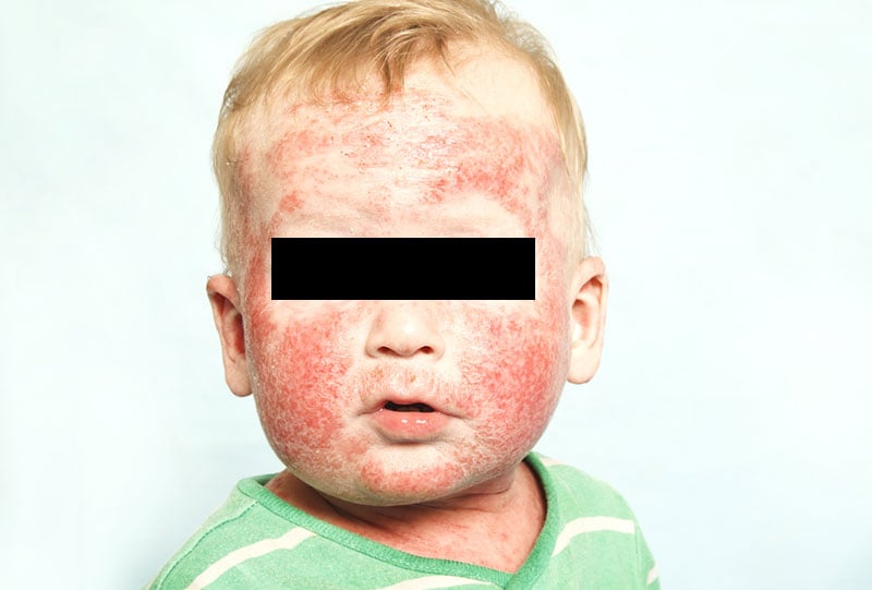 Fotos de dermatite atópica (bebês, crianças e adultos)