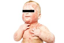 Fotos de dermatite atópica (bebês, crianças e adultos)