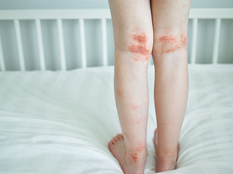 Eccema Y Dermatitis Atópica – Eccema (dermatitis atópica): síntomas ...
