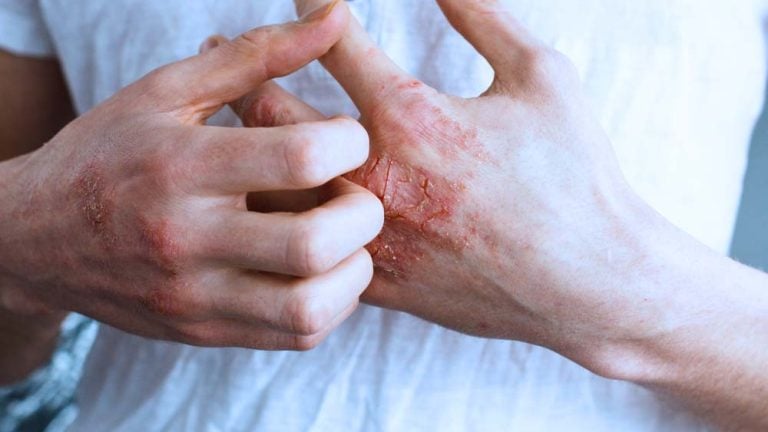 Brotoeja em bebê (miliária): Causas e tratamento