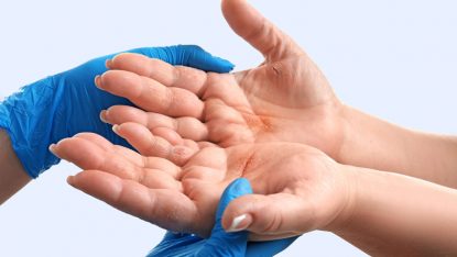 DERMATITIS DE CONTACTO: causas y tratamiento • MD.Saúde