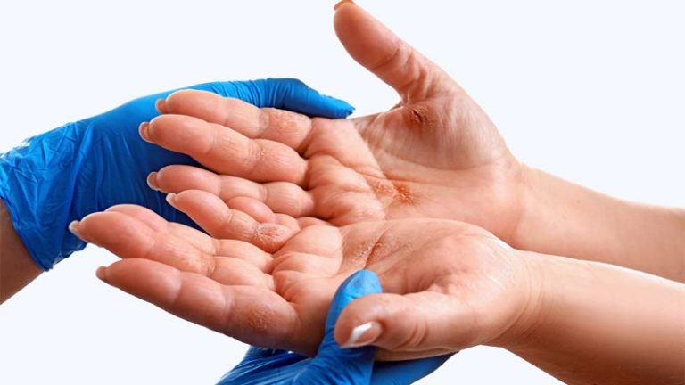 Dermatite de contato: causas, sinais e tratamento