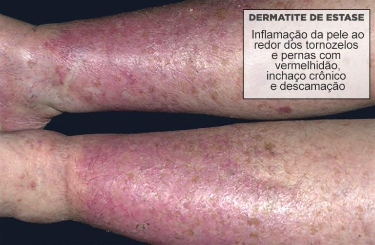 Dermatite de estase: o que é, causas, sintomas e tratamento