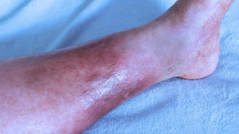 Brotoeja em bebê (miliária): Causas e tratamento