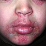 Dermatite perioral: o que é, causas, sintomas e tratamento