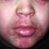 Dermatite perioral: o que é, causas, sintomas e tratamento